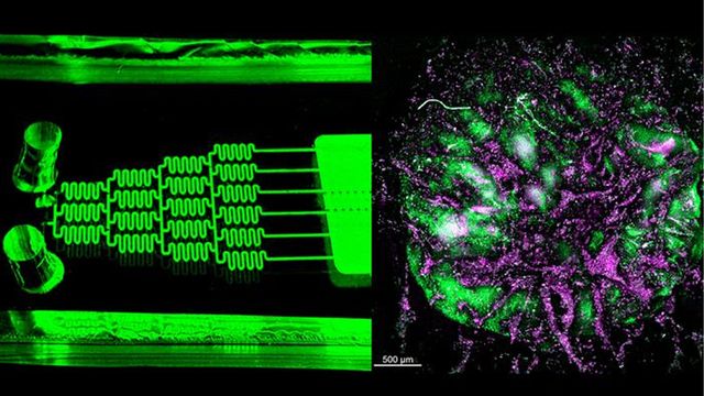 Lab-Grown Model Shows Weak Immune Response in Cancer Patient ...