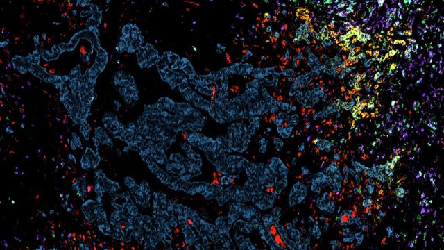 Uncover The Role Of T Cells In Cancer With Spatial Biology Technology