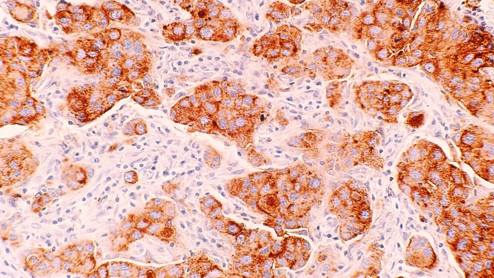 Breast Cancer Cells Extract Energy from Fat Via Gap Junction ...