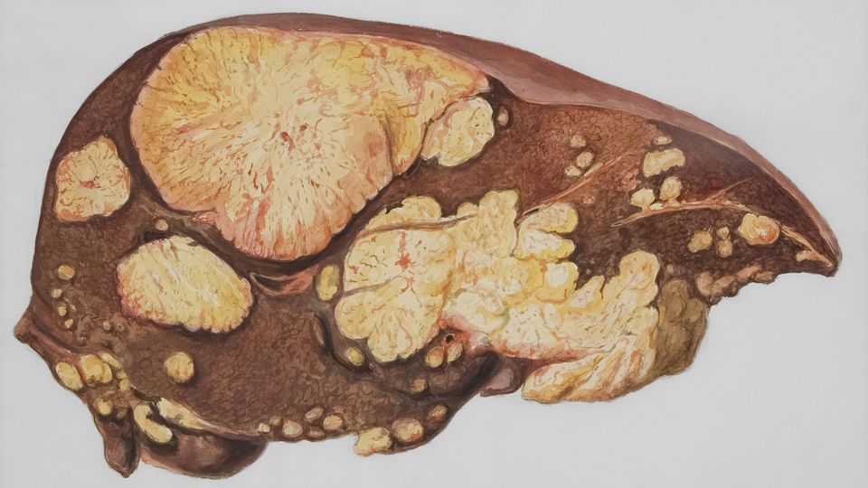 Cyclophilin Drug Reduces Fibrosis in Liver Disease | Technology Networks