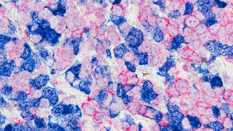 Colibactin-Producing E. Coli Linked to Cancer Risk In FAP | Technology ...