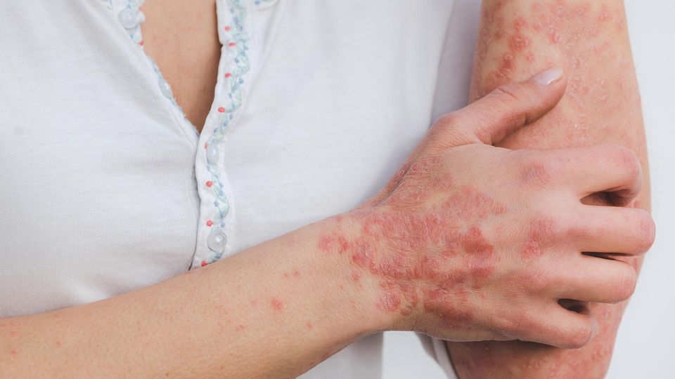 FABP5 Blockade Offers New Psoriasis Treatment | Technology Networks