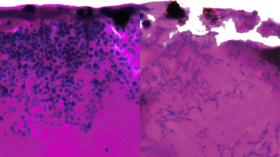 Fungal Infection Alert: New Hope Against Candida Auris | Technology ...