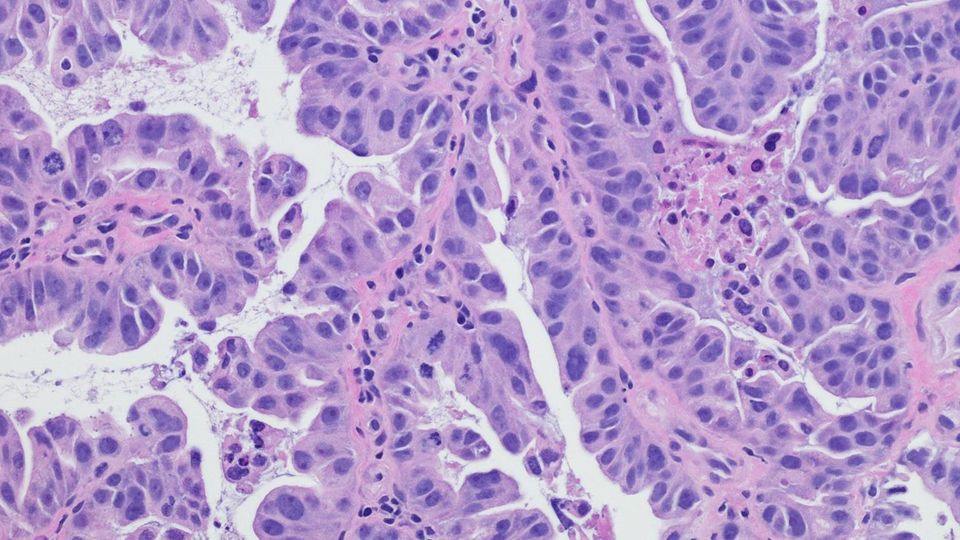 How Colon Stiffness Drives Early-Onset Colorectal Cancer | Technology ...