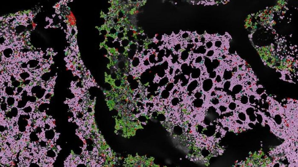 Immune Cell Atlas Reveals New Insights Into Multiple Myeloma ...