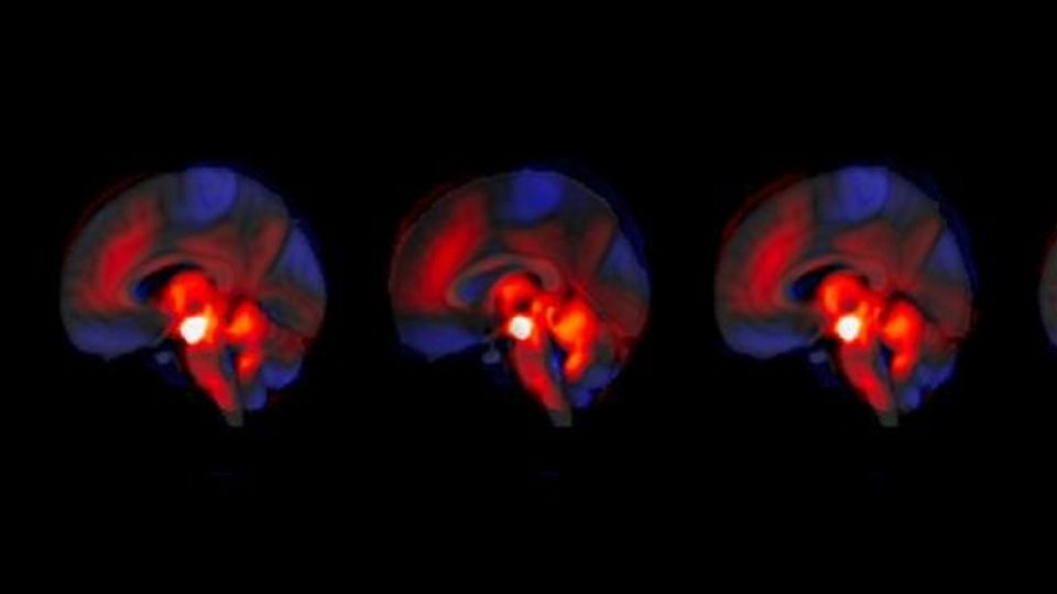 Schizophrenia Study Links Cerebellum to Apathy and Motivation Loss ...