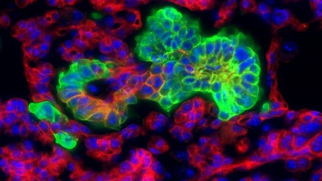 Highly Plastic Cells Drive Tumor Growth and Drug Resistance ...
