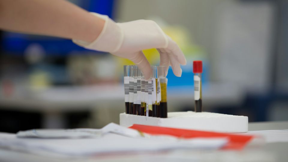 Albumin Identified as Natural Defense Against Mucormycosis | Technology ...