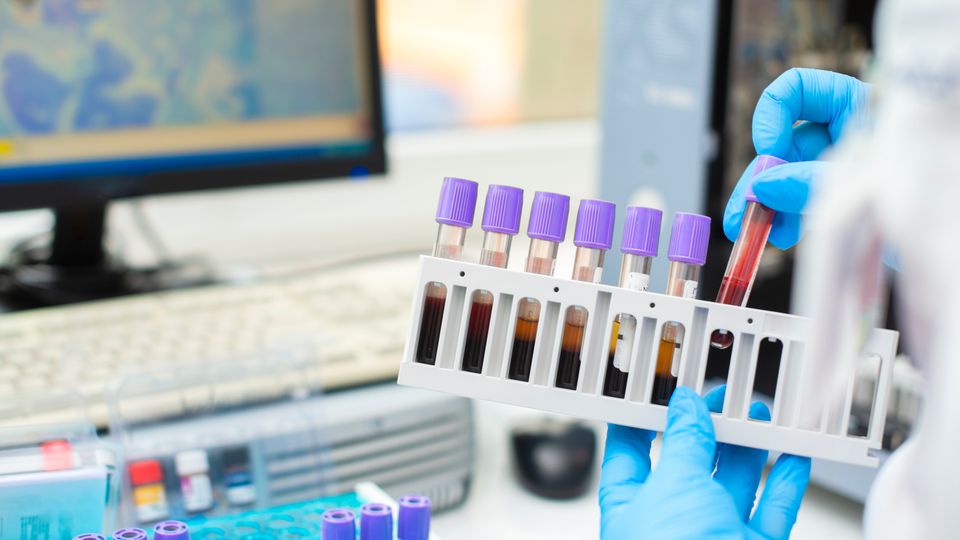 Blood Lactate Is a Key Biomarker for ALS Prognosis | Technology Networks