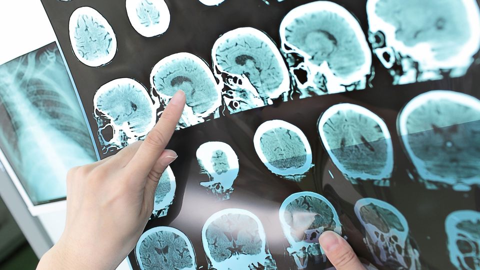 Brain Imaging Study Reveals ADHD Biotypes | Technology Networks