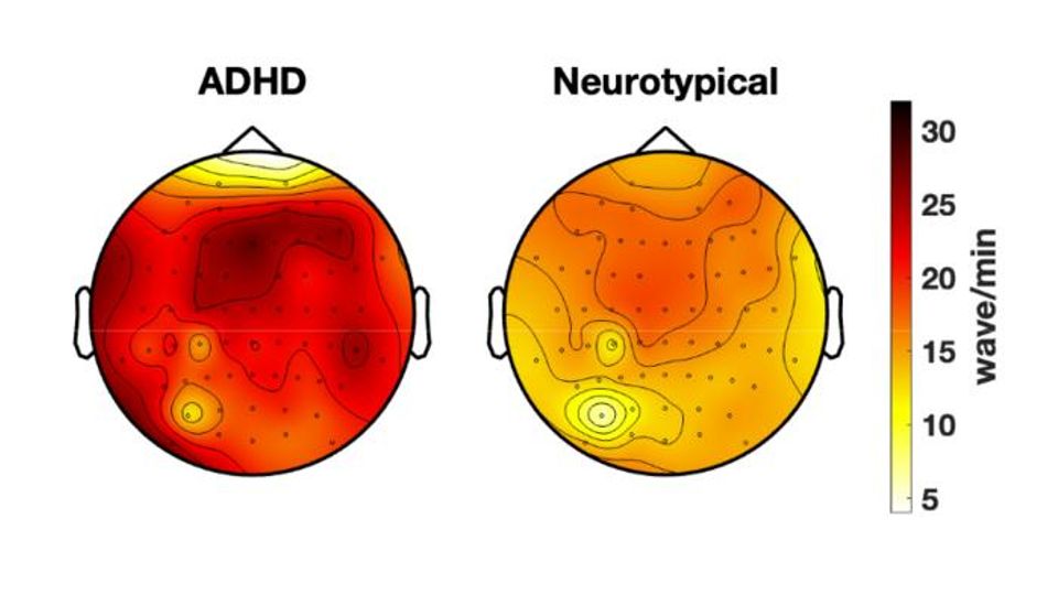 ADHD Inattention Tied to Sleep-Like Brain Waves | Technology Networks
