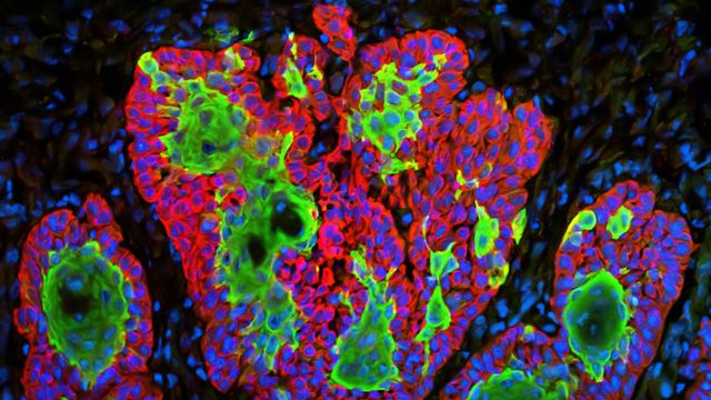 Why Similar Cancers Behave Differently in the Body | Technology Networks