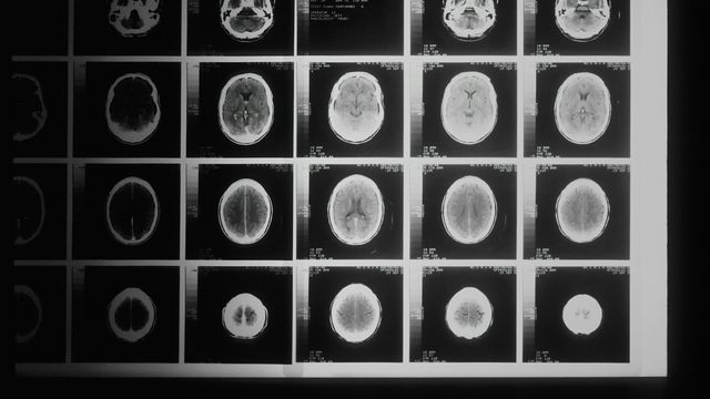 Brain Imaging Identifies Two Migraine Subtypes | Technology Networks