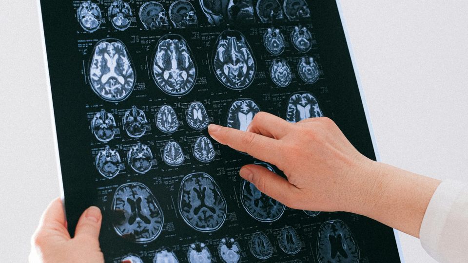 Two Brain-Based Autism Subtypes Identified | Technology Networks