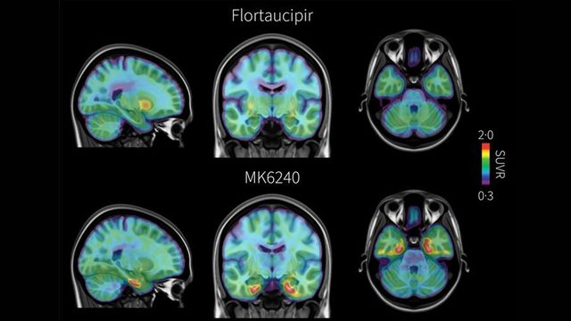 Tau Imaging Enhances Alzheimer’s Diagnosis | Technology Networks