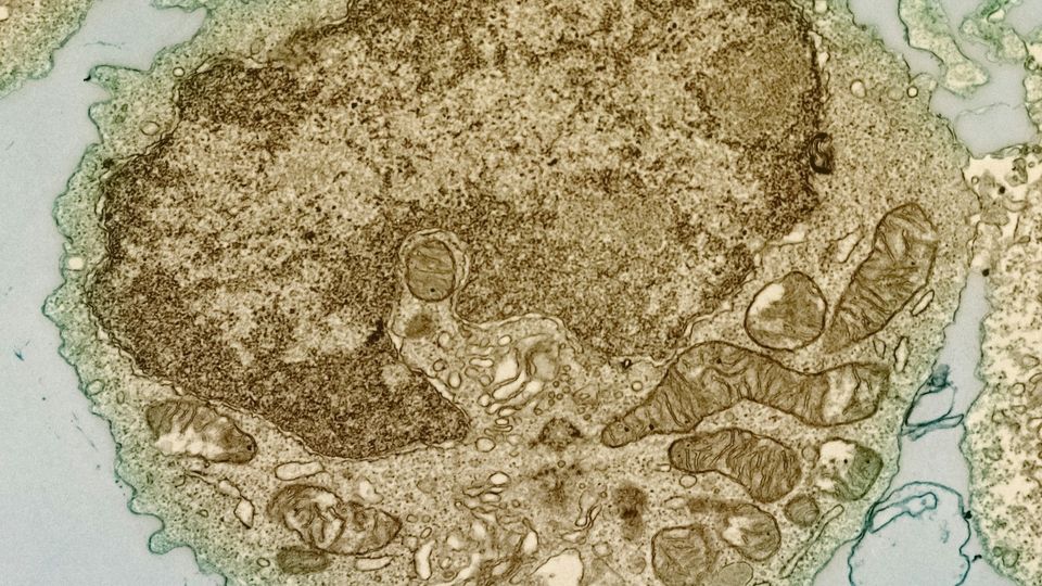 Obexelimab Reduces Relapse in IgG4-Related Disease | Technology Networks