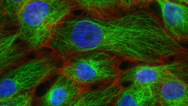 GLP-1 Use Associated With Lower Breast Cancer Occurrence | Technology ...
