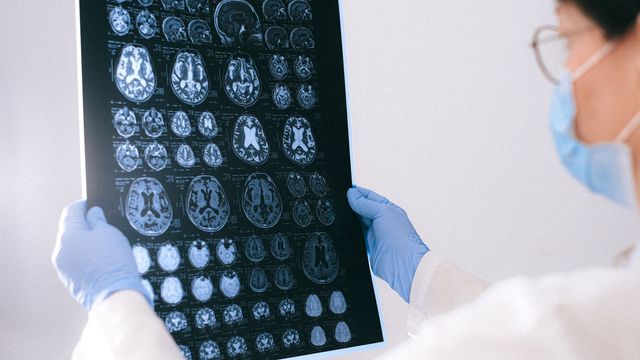 Brain Tumor Study Maps Meningioma Cell States | Technology Networks
